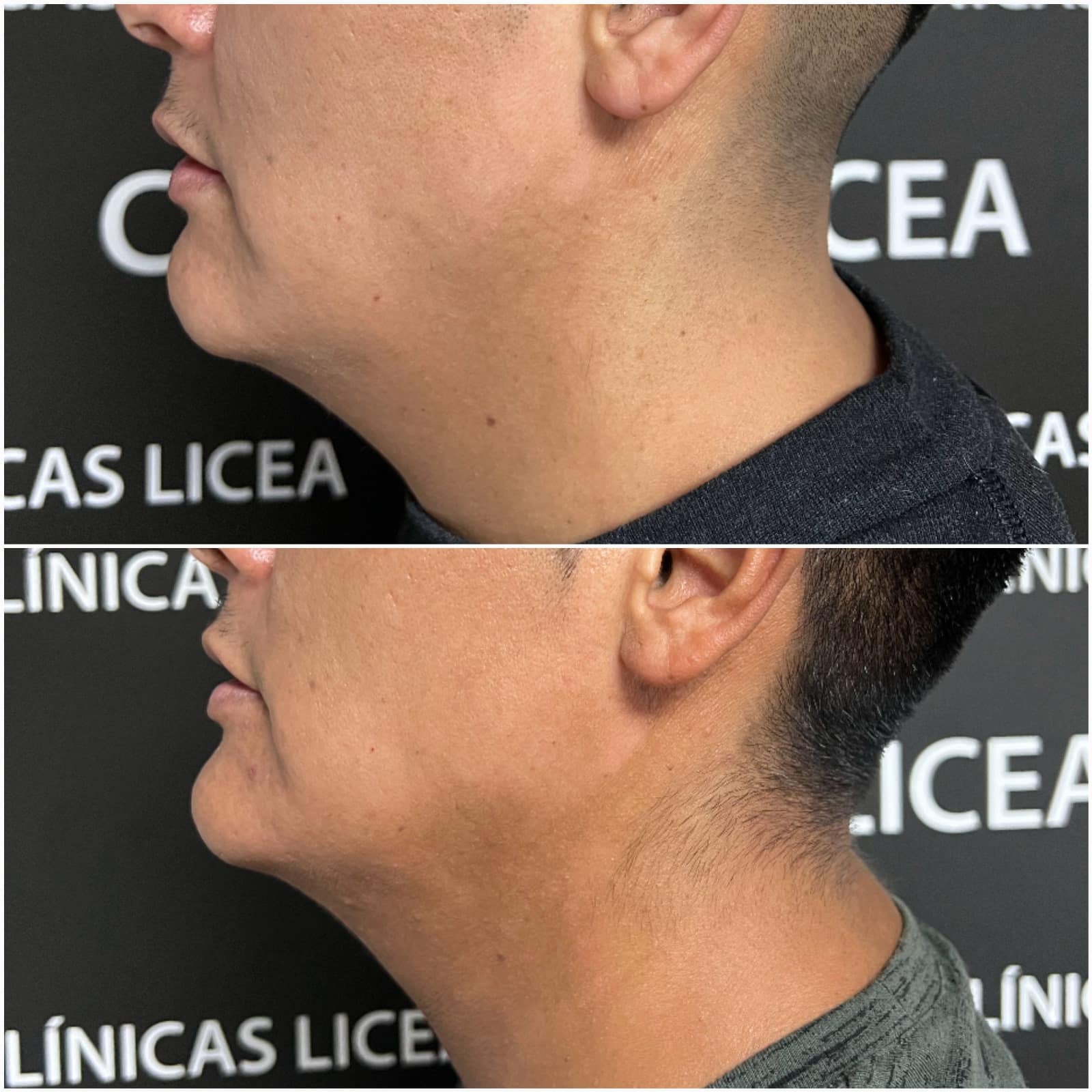 Laser endolifting papada en Zaragoza - Clínicas Licea